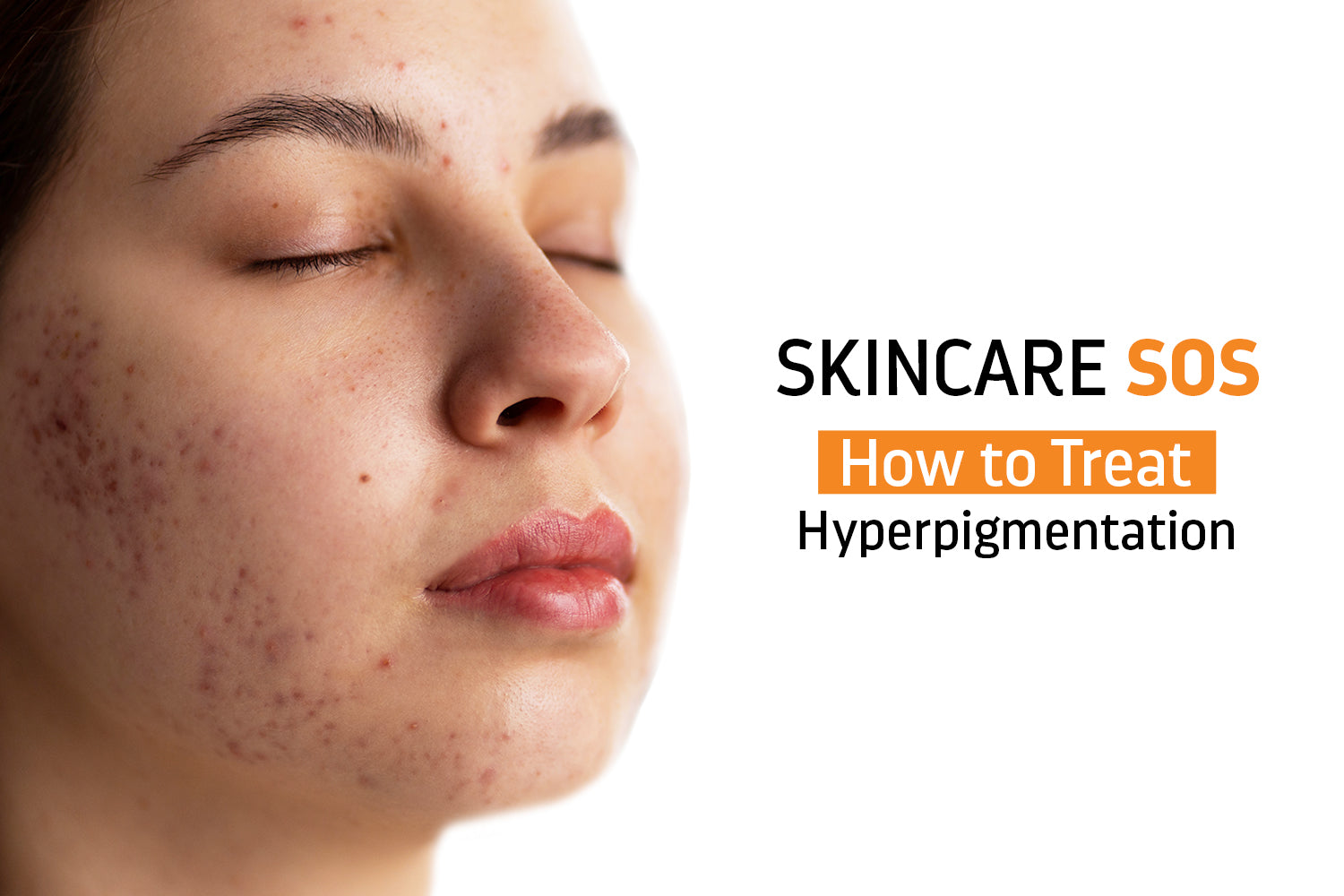 How to Treat Hyperpigmentation: Effective Solutions for Clear, Even ...